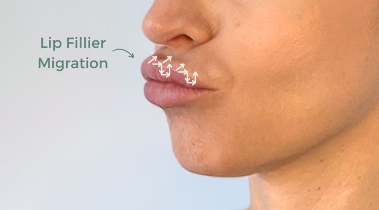 Dissolving Lip Filler – The Facts! - Alabaster Aesthetics