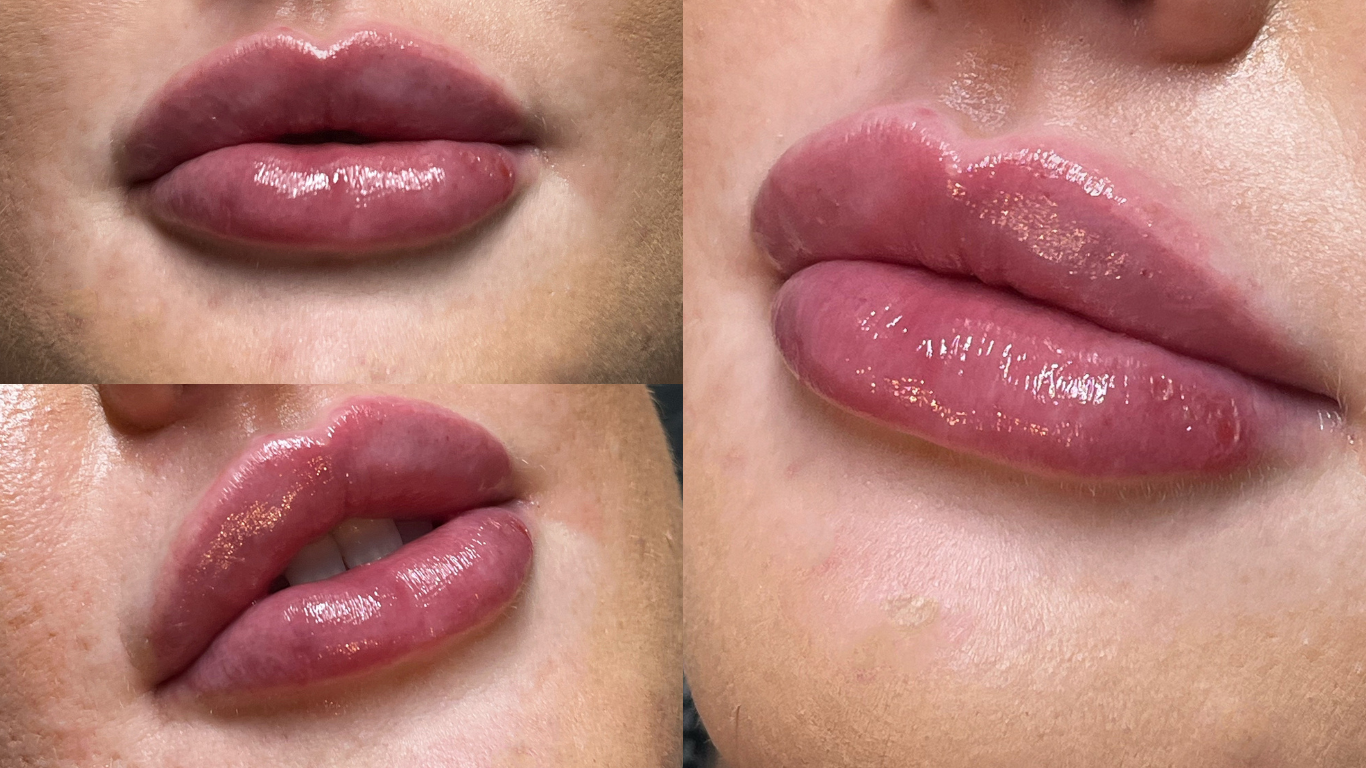 Lip Fillers - Alabaster Aesthetics